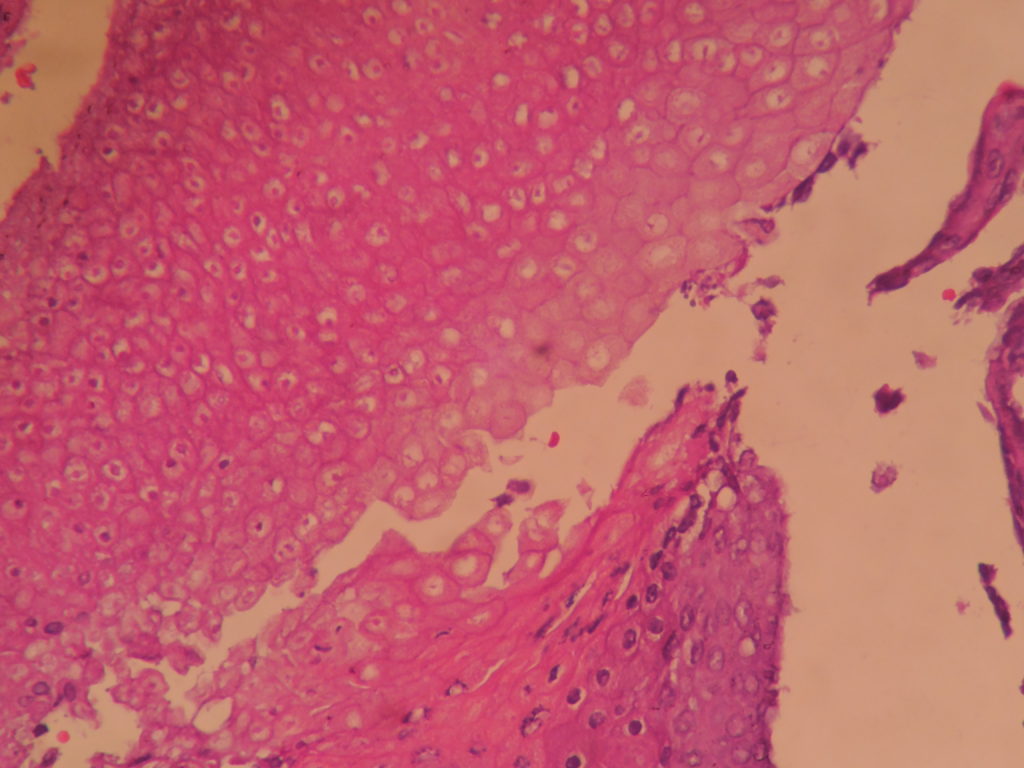 PILOMATRICOMA – Histopathology.guru