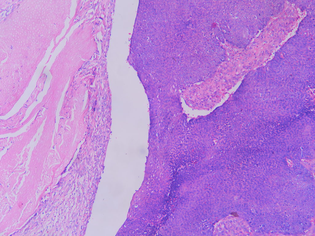 PILOMATRICOMA – Histopathology.guru
