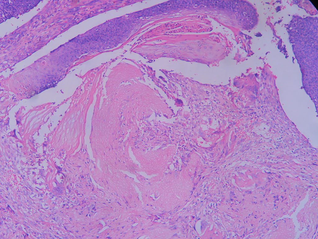 PILOMATRICOMA – Histopathology.guru