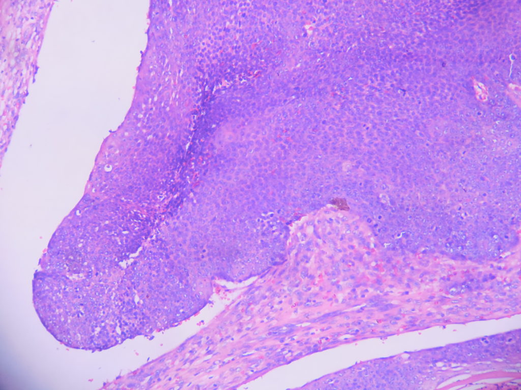 PILOMATRICOMA – Histopathology.guru
