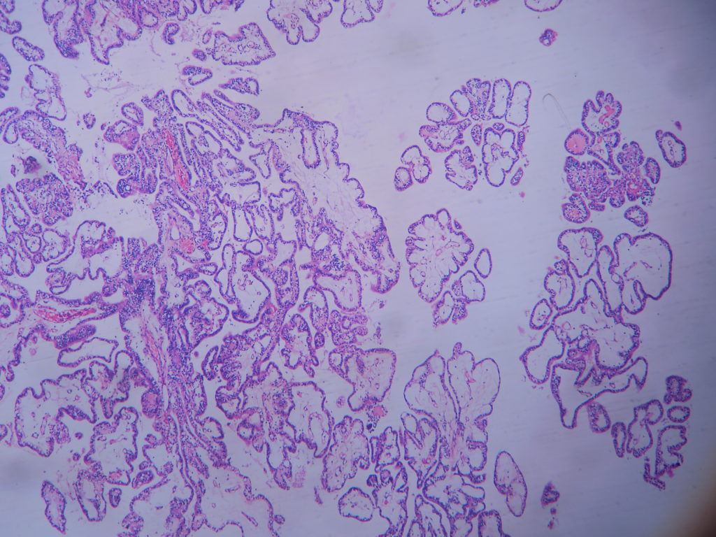 CHOROID PLEXUS PAPILLOMA – Histopathology.guru