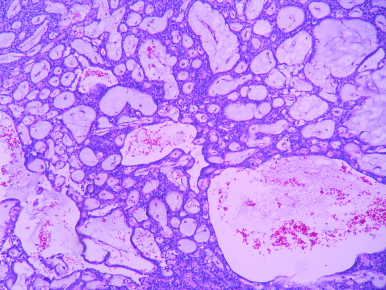 SOLID-PSEUDOPAPILLARY NEOPLASM OF PANCREAS – Histopathology.guru