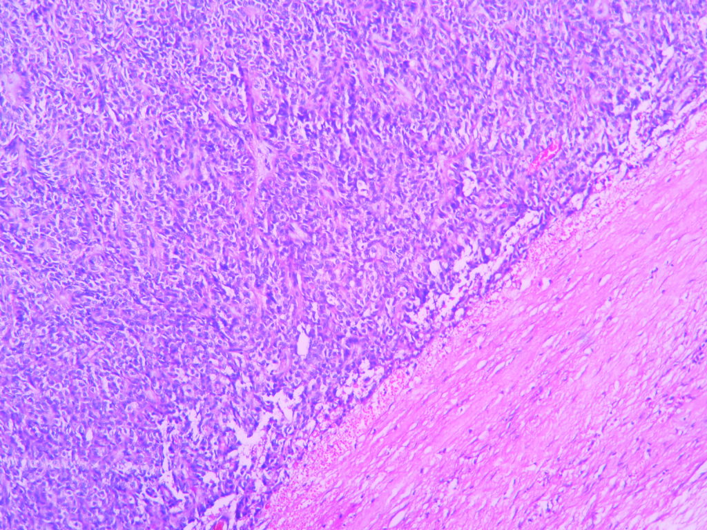 SOLID-PSEUDOPAPILLARY NEOPLASM OF PANCREAS – Histopathology.guru