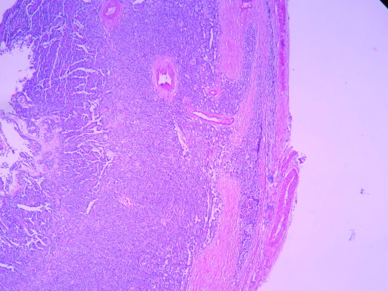 SOLID-PSEUDOPAPILLARY NEOPLASM OF PANCREAS – Histopathology.guru