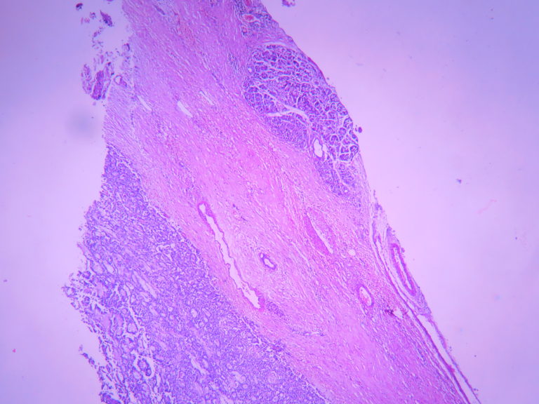 SOLID-PSEUDOPAPILLARY NEOPLASM OF PANCREAS – Histopathology.guru