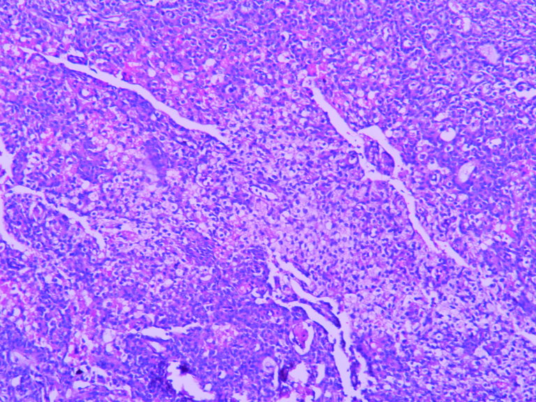 SOLID-PSEUDOPAPILLARY NEOPLASM OF PANCREAS – Histopathology.guru