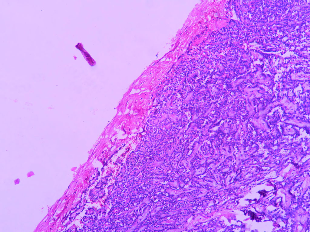 SOLID-PSEUDOPAPILLARY NEOPLASM OF PANCREAS – Histopathology.guru