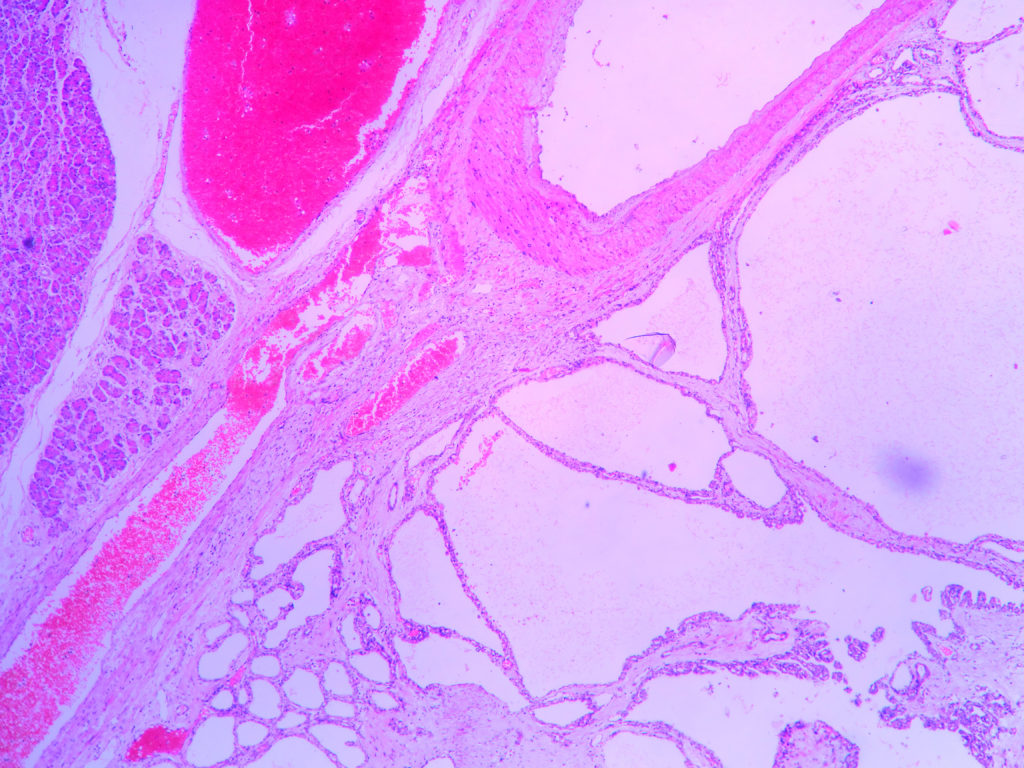 SEROUS CYSTADENOMA OF PANCREAS – Histopathology.guru