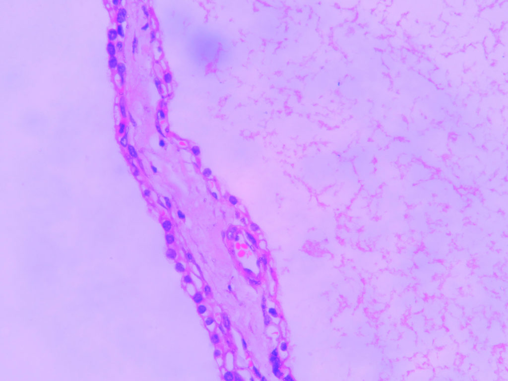 SEROUS CYSTADENOMA OF PANCREAS – Histopathology.guru
