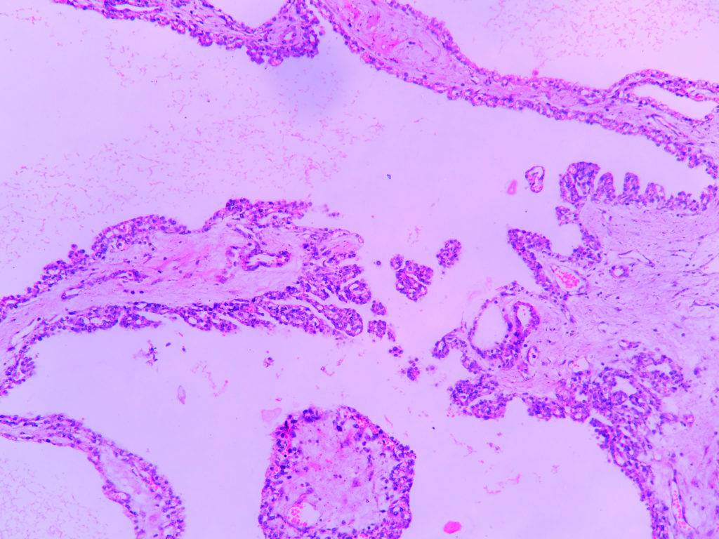 SEROUS CYSTADENOMA OF PANCREAS – Histopathology.guru