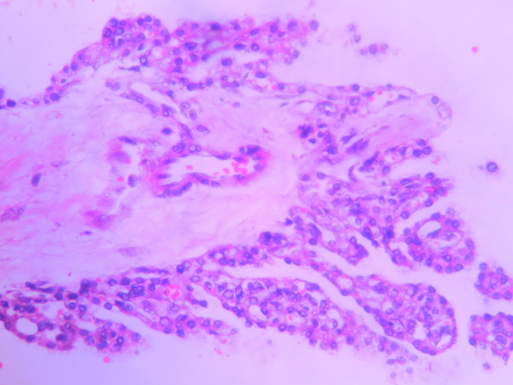 SEROUS CYSTADENOMA OF PANCREAS – Histopathology.guru