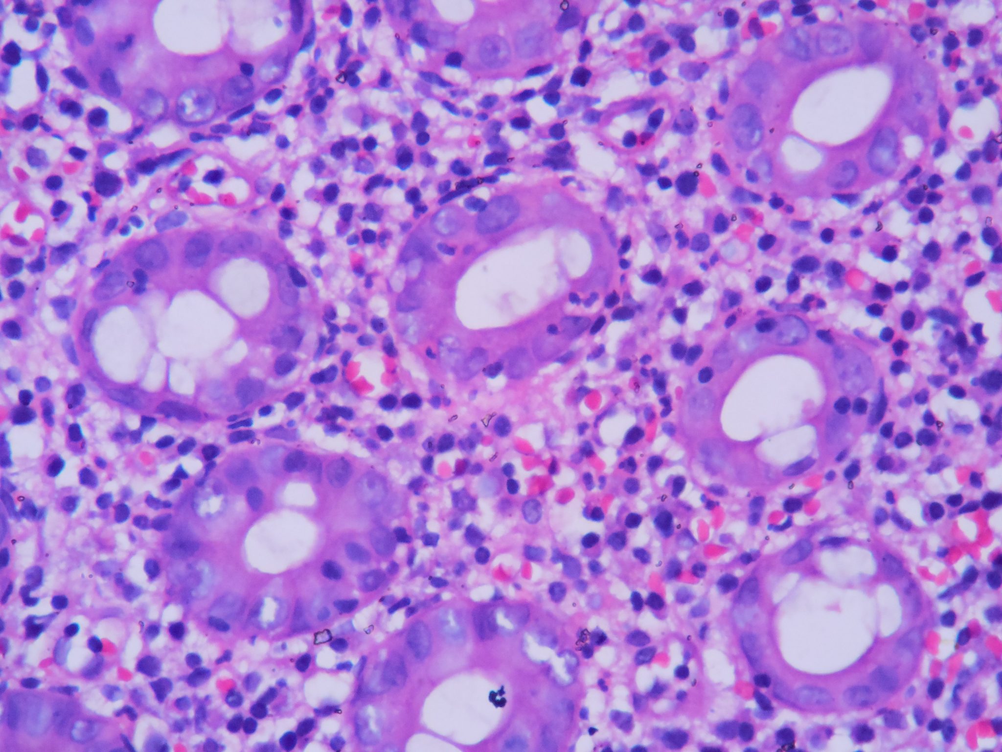 Ulcerative colitis – Histopathology.guru