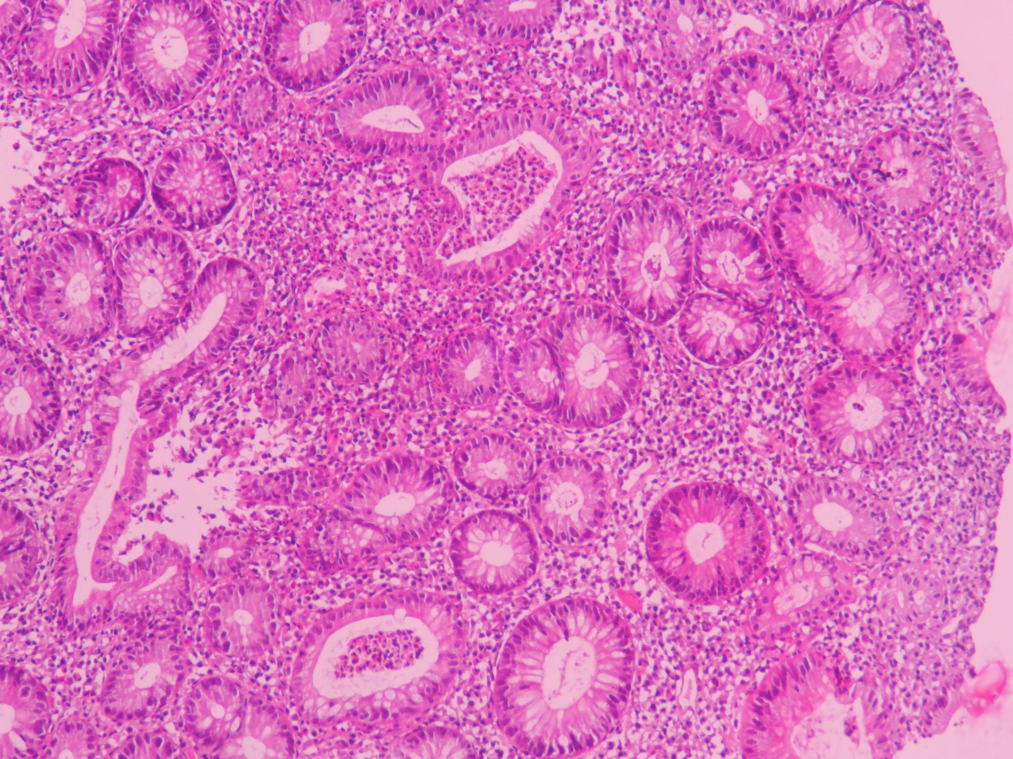Ulcerative colitis – Histopathology.guru