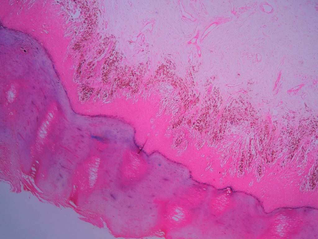 Melanoma Histopathology Guru