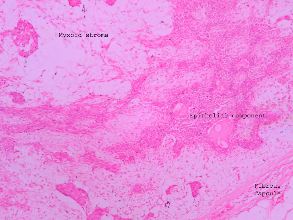 Pleomorphic adenoma – Histopathology.guru