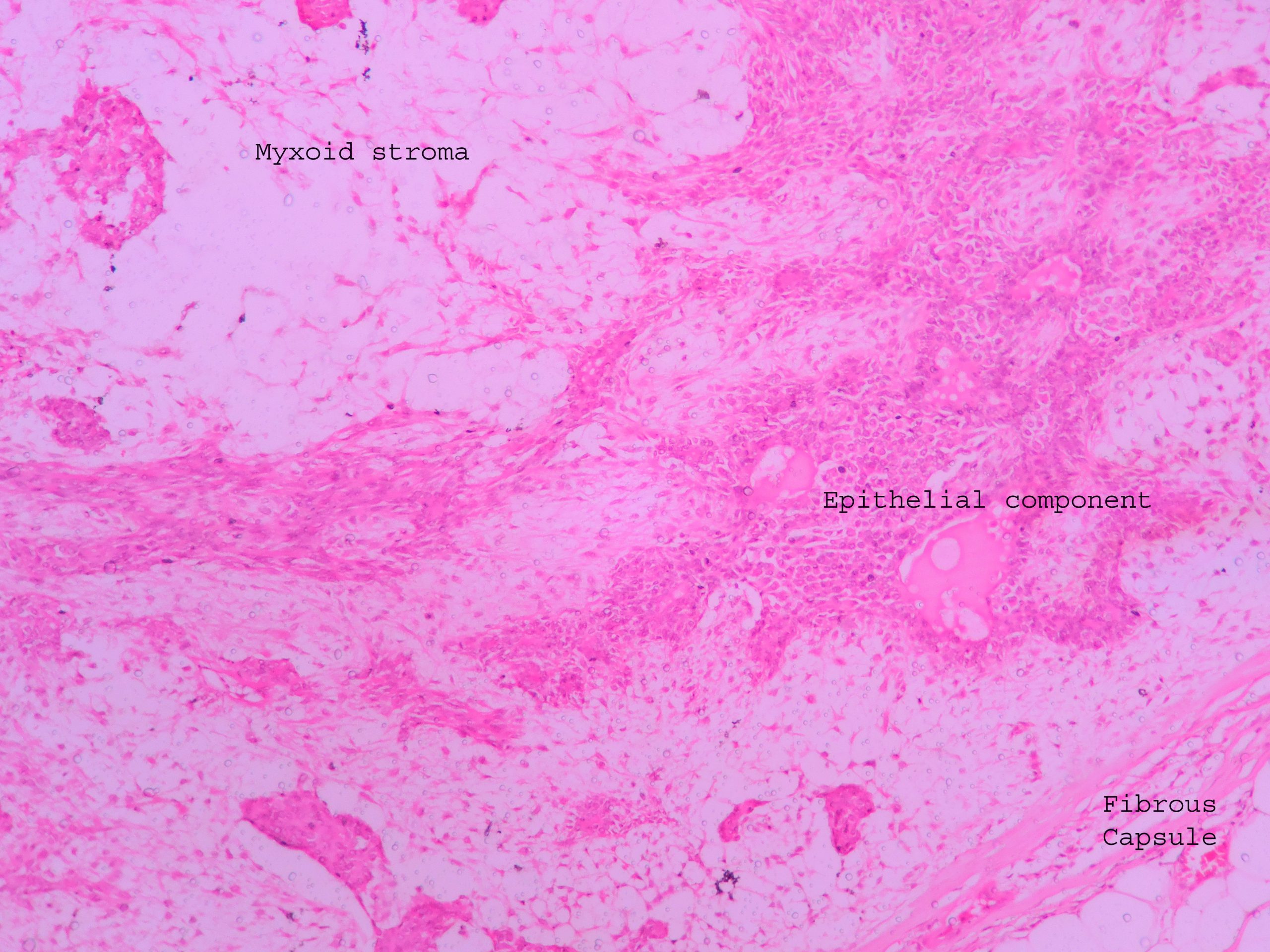 Pleomorphic adenoma – Histopathology.guru