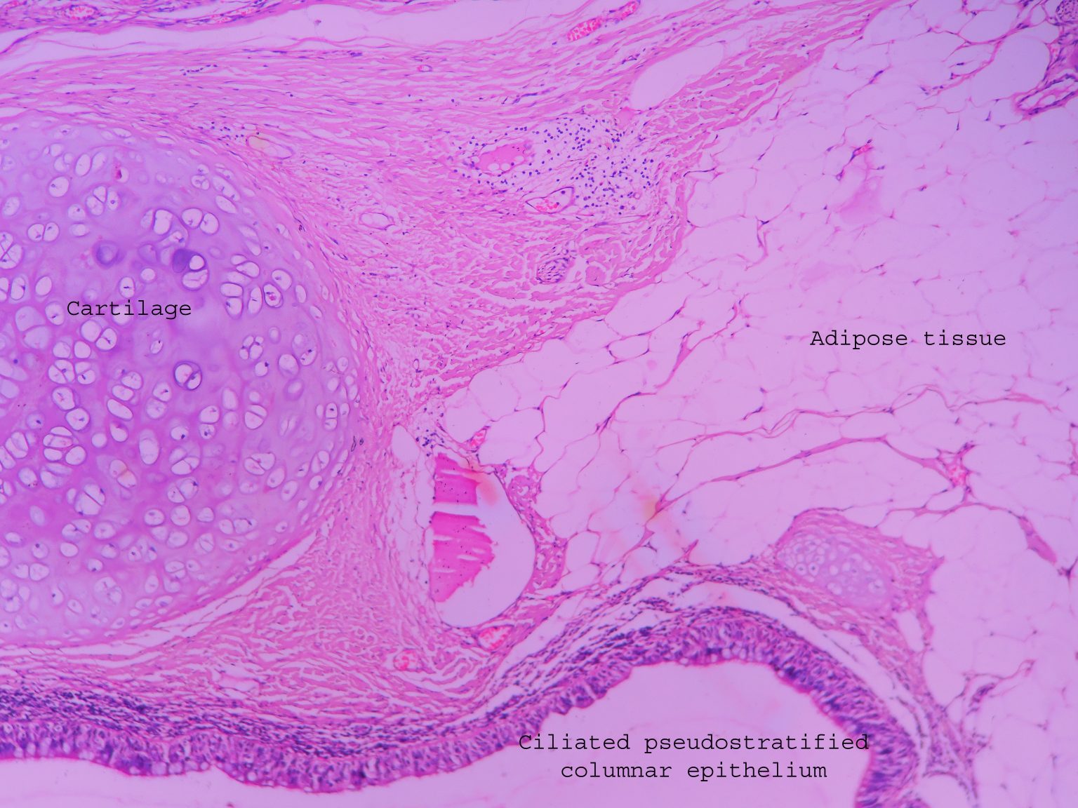 Dermoid Cyst Ovary Histopathologyguru