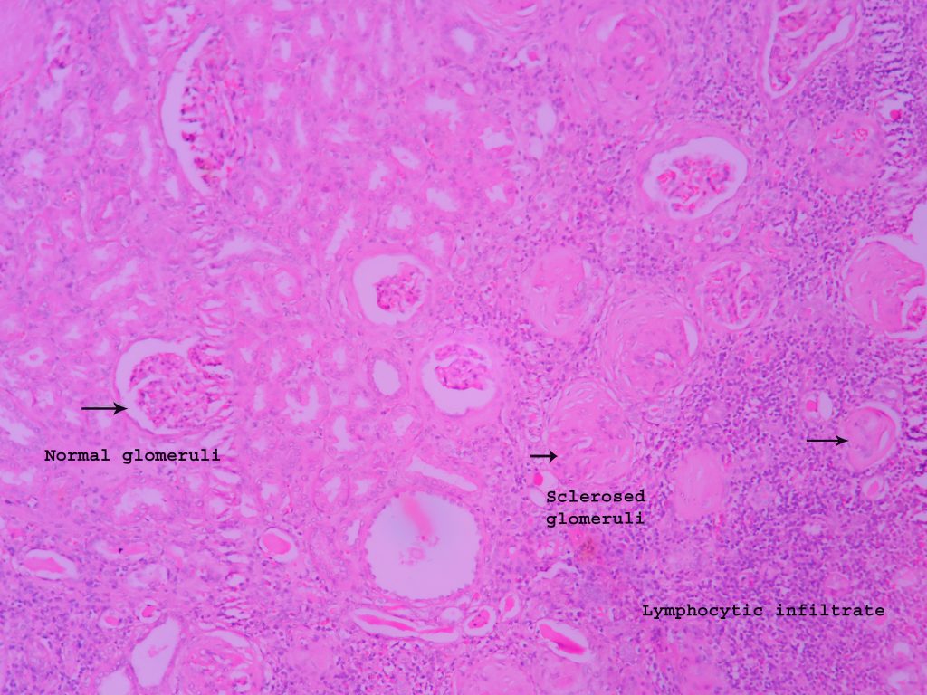 Chronic pyelonephritis – Histopathology.guru