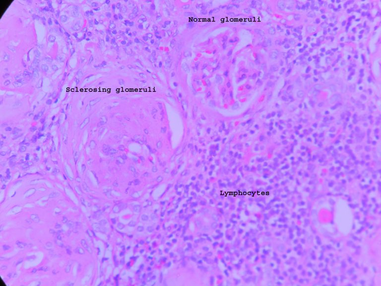 Chronic pyelonephritis – Histopathology.guru