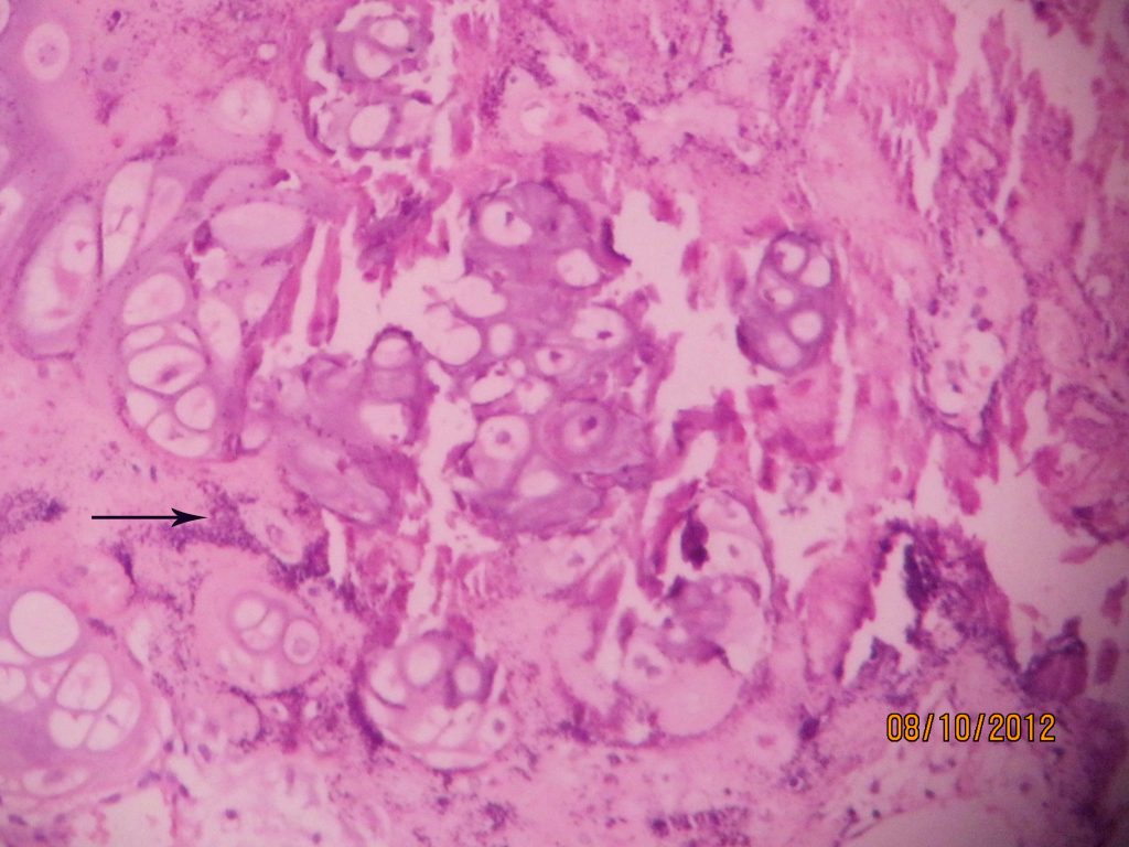 CHONDROSARCOMA – Histopathology.guru