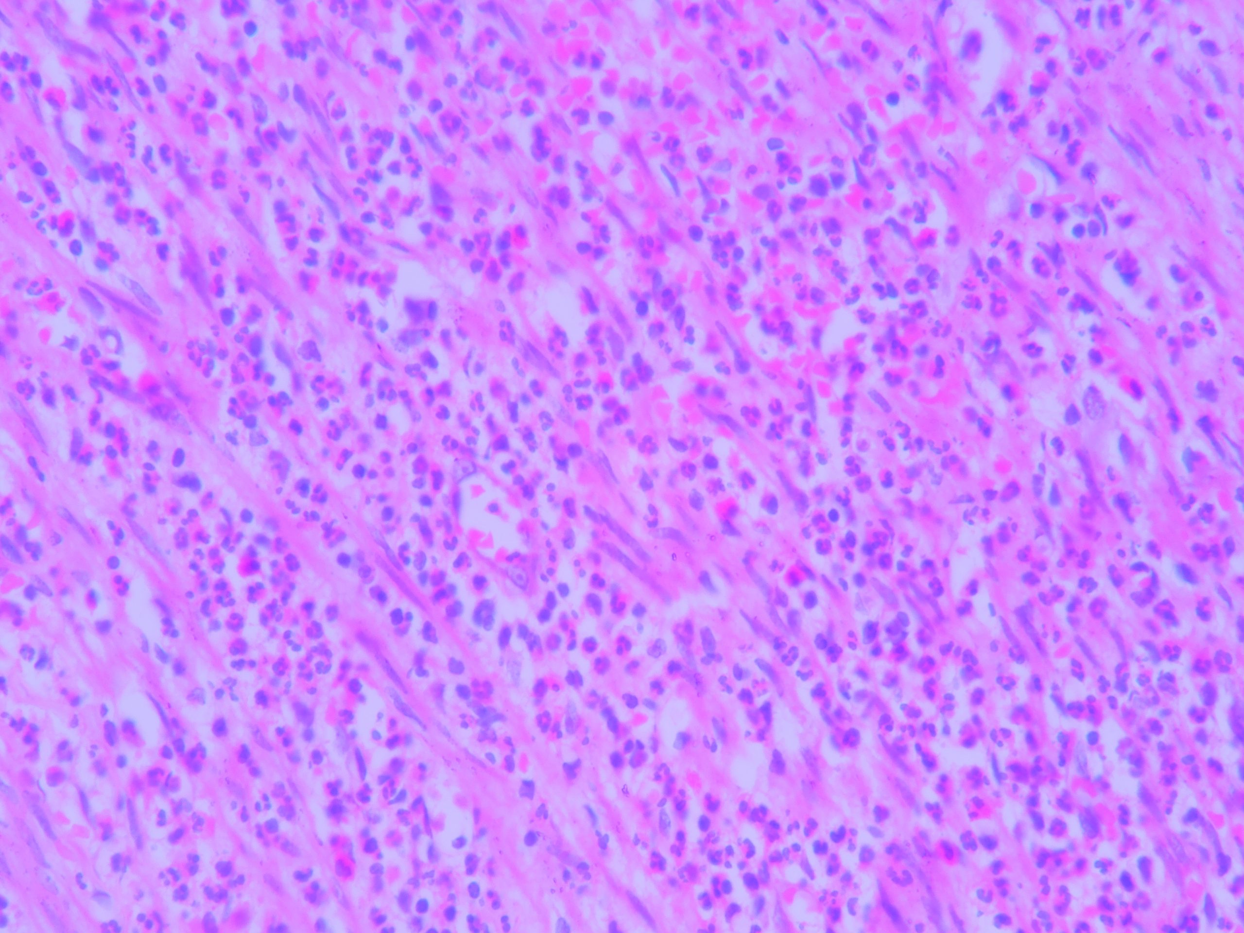 Acute Appendicitis – Histopathology.guru