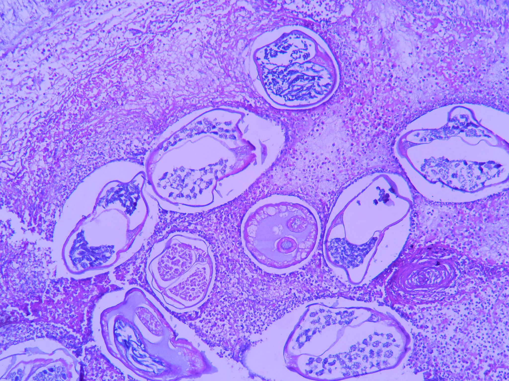 Lymph node – Filaria – Histopathology.guru