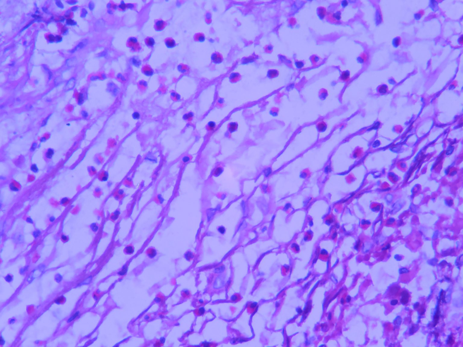 Lymph node – Filaria – Histopathology.guru