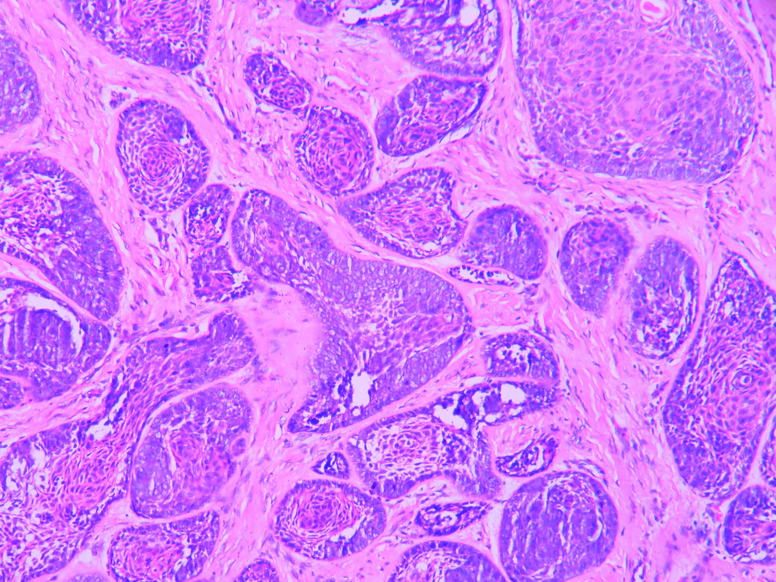 ADAMANTINOMA – Histopathology.guru
