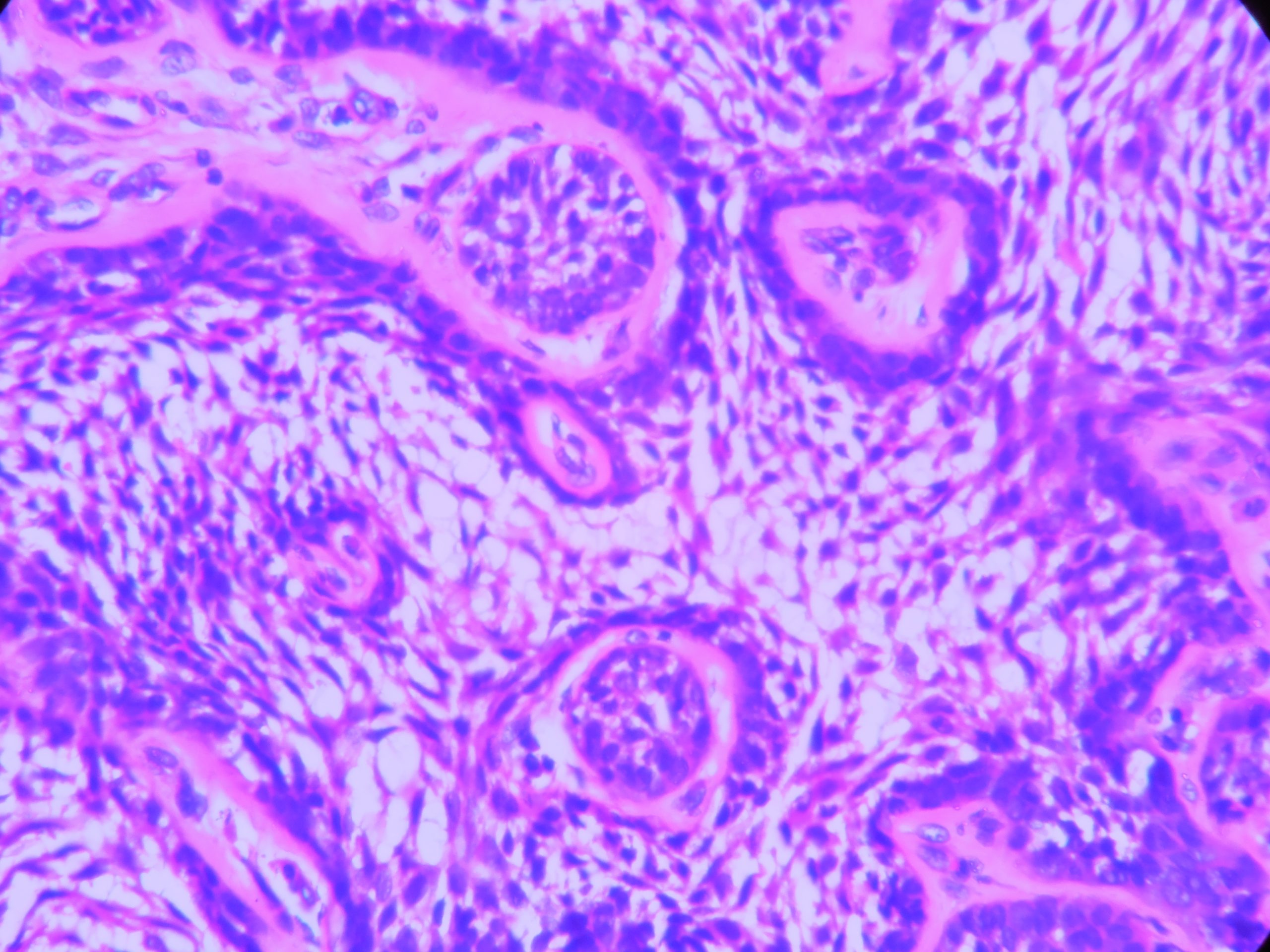 ADAMANTINOMA – Histopathology.guru