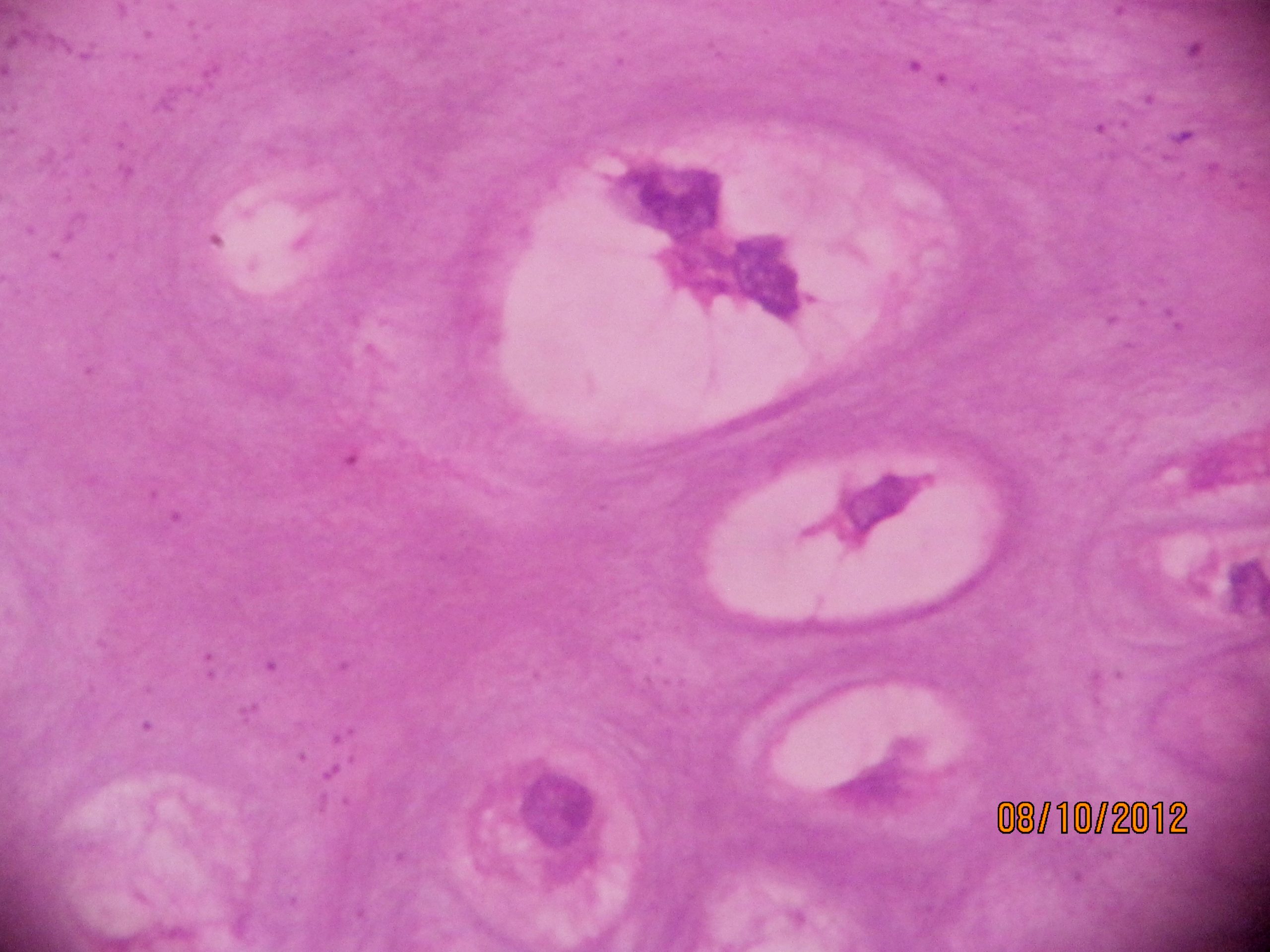 CHONDROSARCOMA – Histopathology.guru