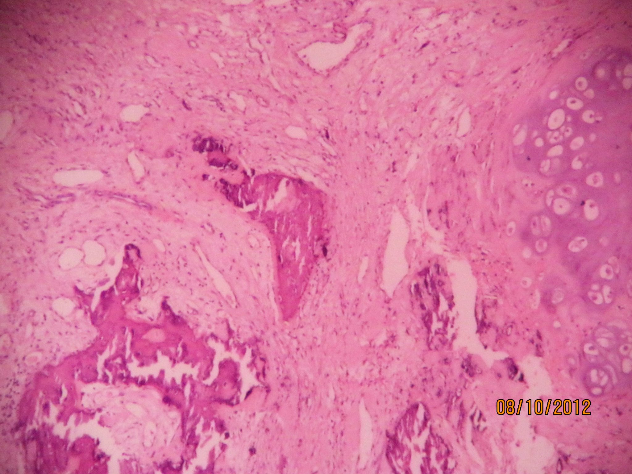 CHONDROSARCOMA (GRADE 1) – Histopathology.guru