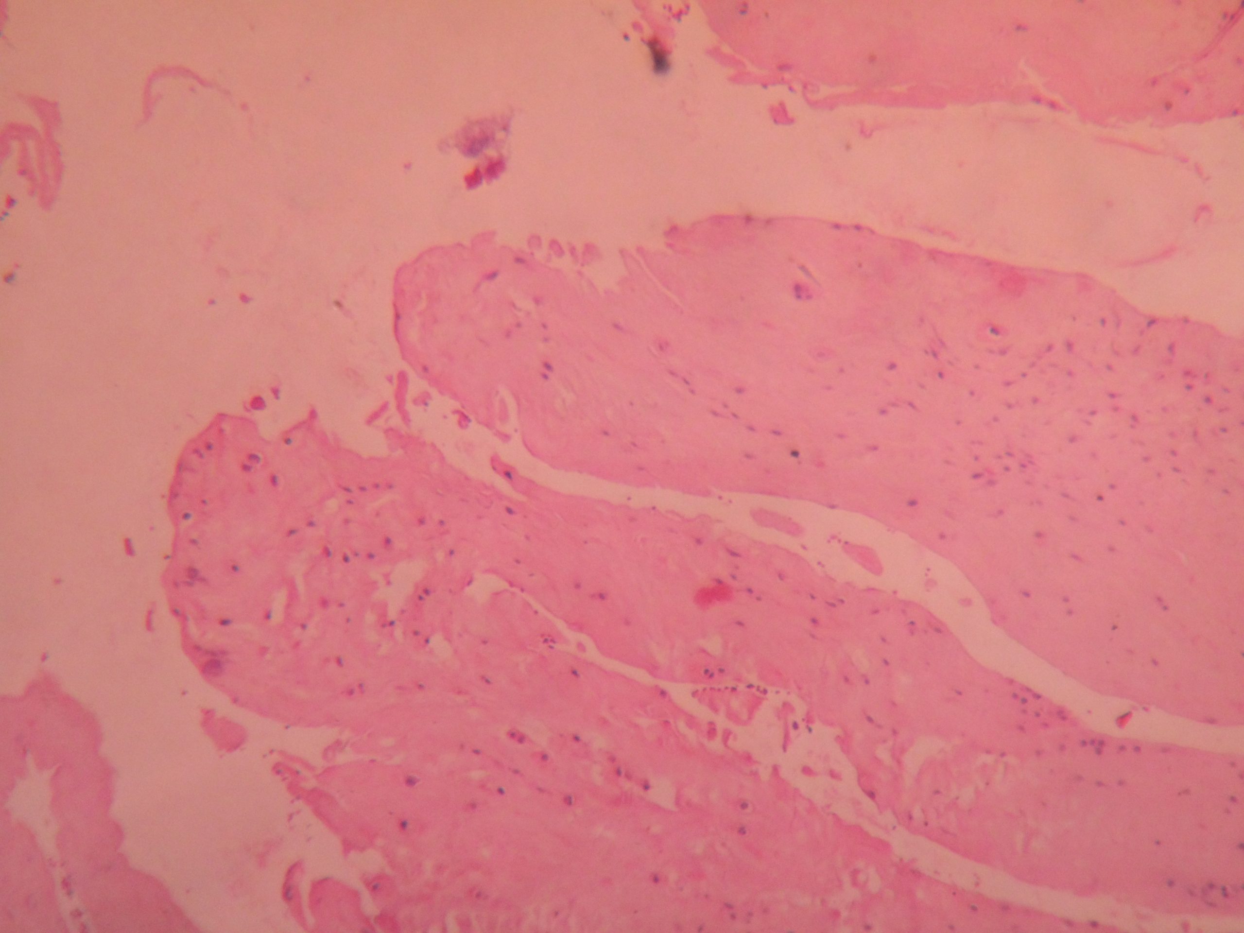MENISCAL CYST – Histopathology.guru