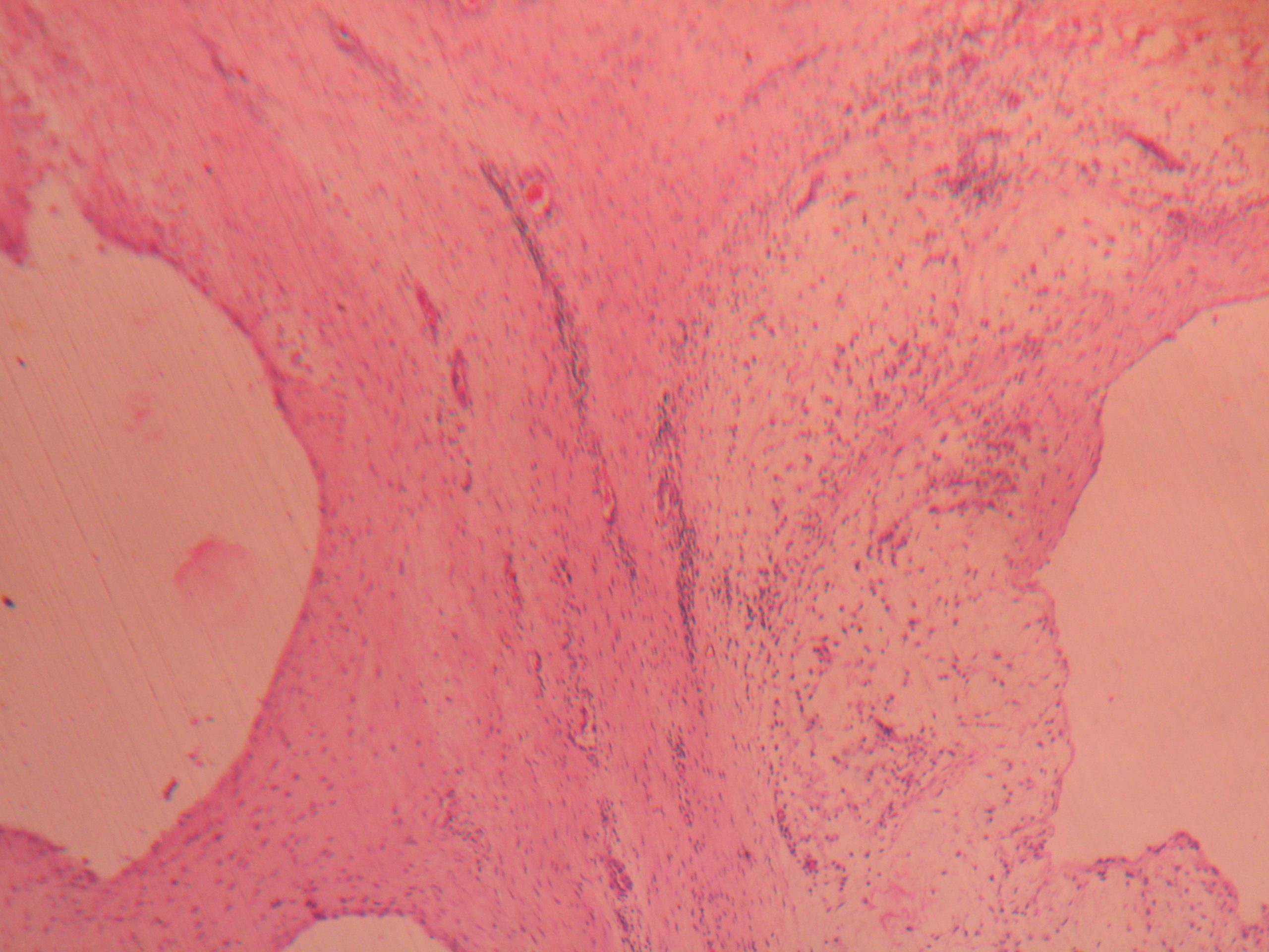 MENISCAL CYST – Histopathology.guru