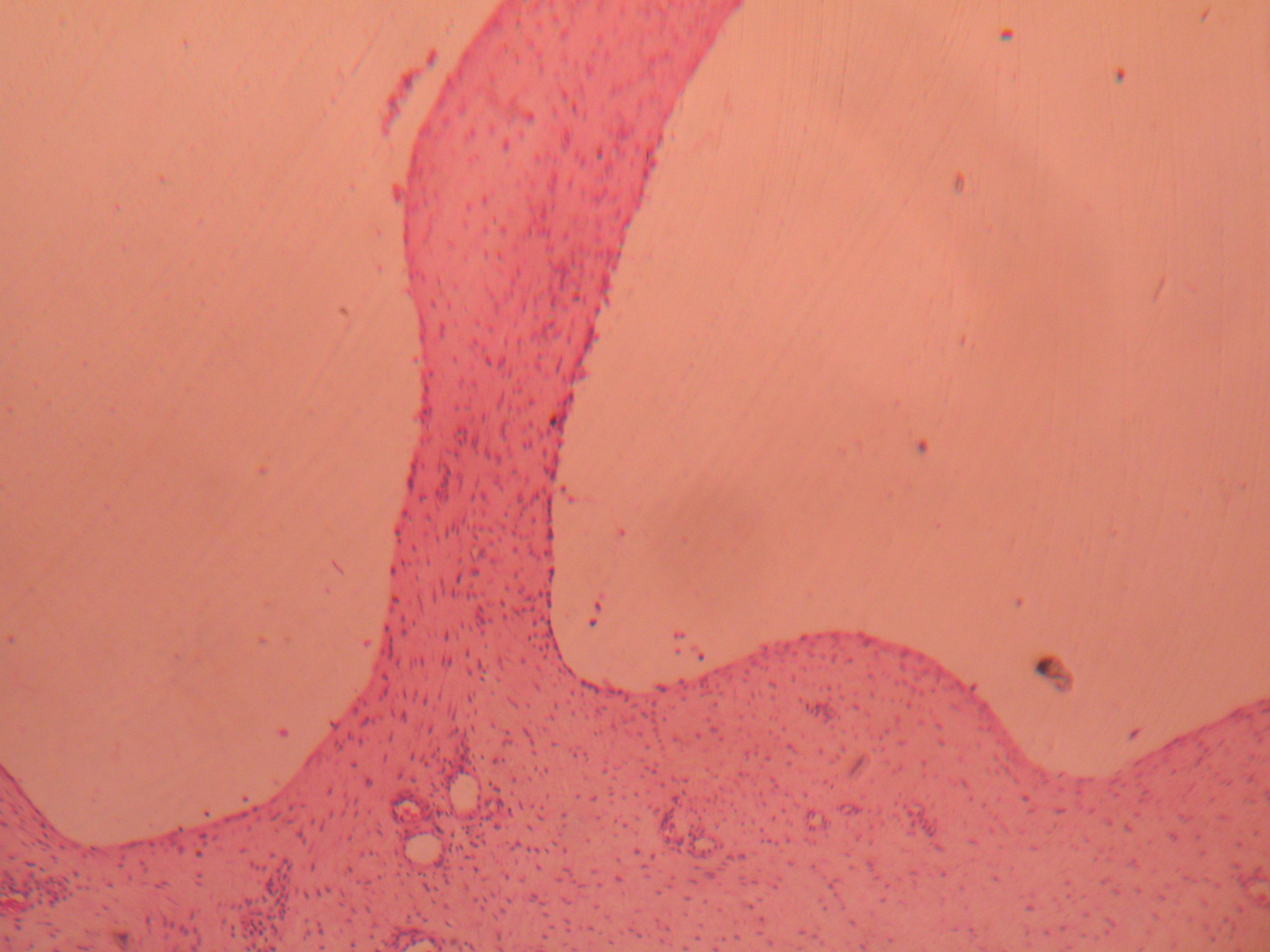 MENISCAL CYST – Histopathology.guru