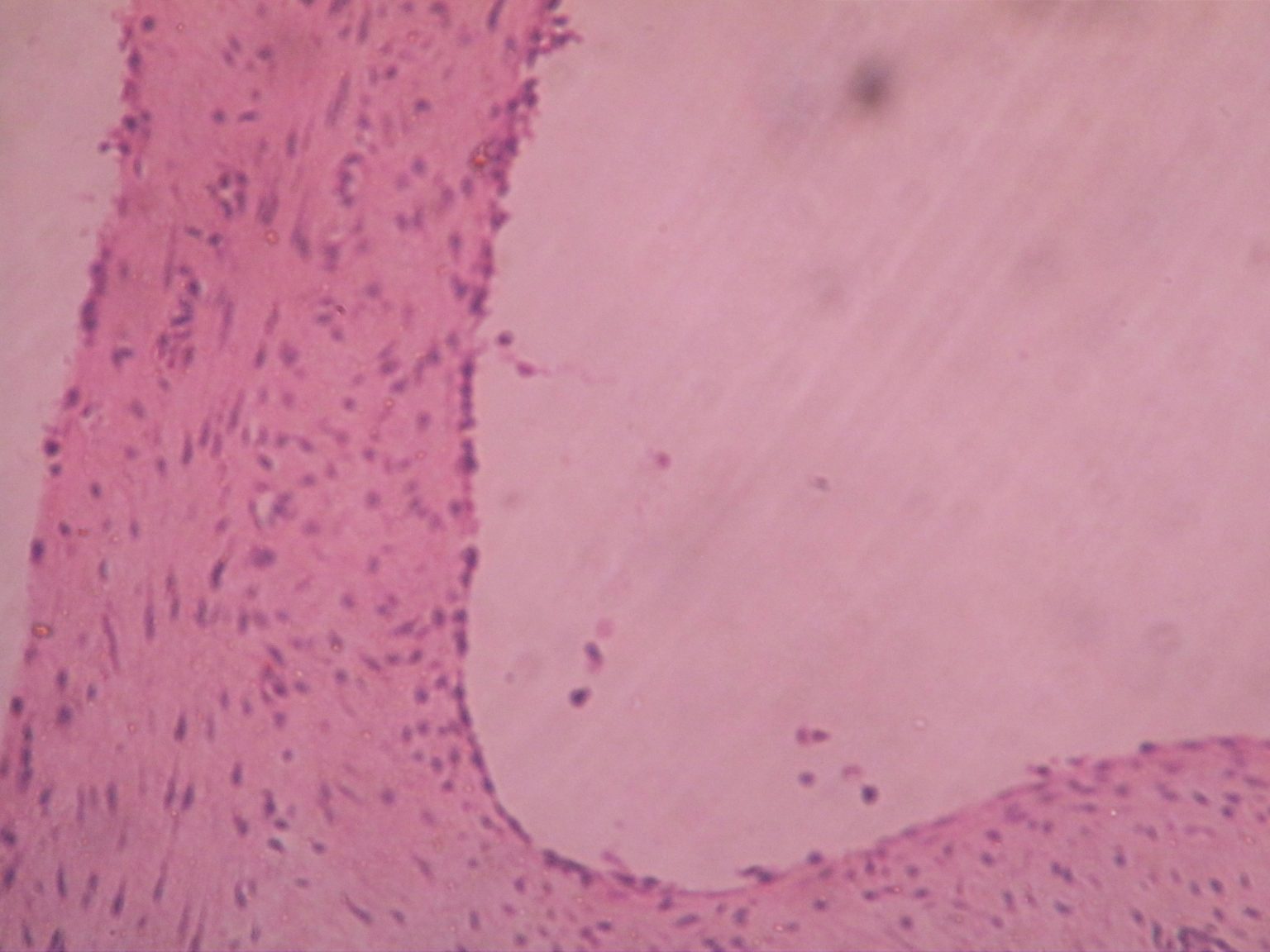 MENISCAL CYST – Histopathology.guru