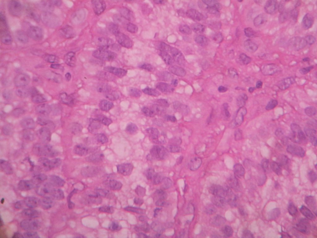 AMELOBLASTOMA – Histopathology.guru