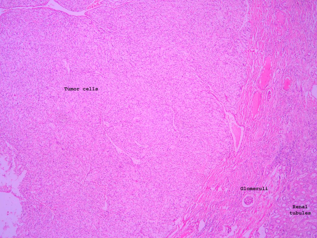 Renal cell carcinoma – UG slide – Histopathology.guru