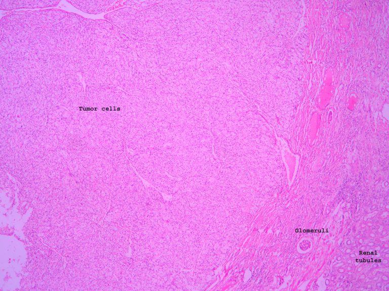 Renal cell carcinoma – UG slide – Histopathology.guru