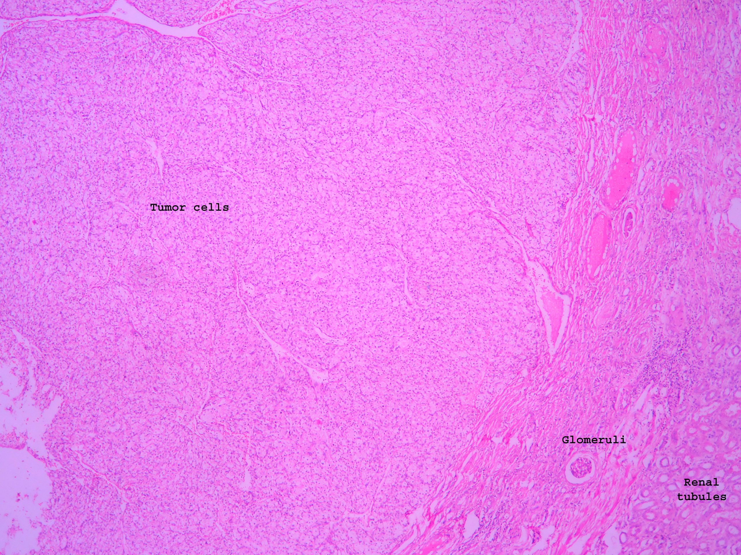 Renal cell carcinoma – UG slide – Histopathology.guru