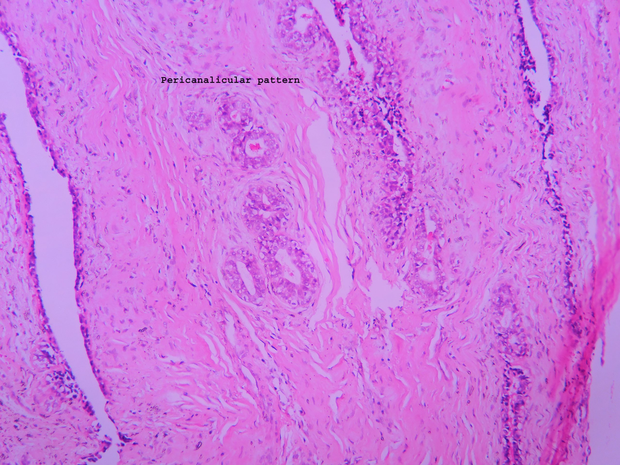 Fibroadenoma – Histopathology.guru