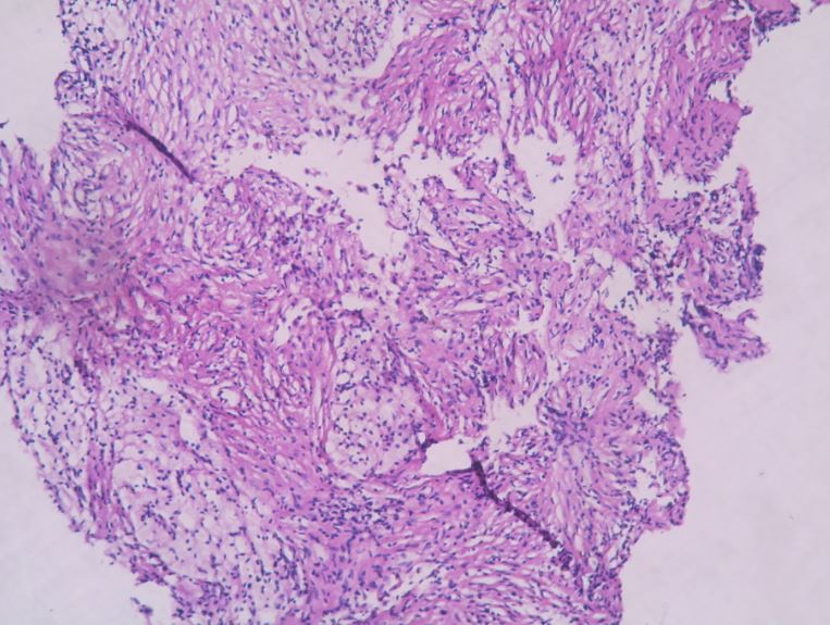 Fibrous histiocytoma of bone – Histopathology.guru