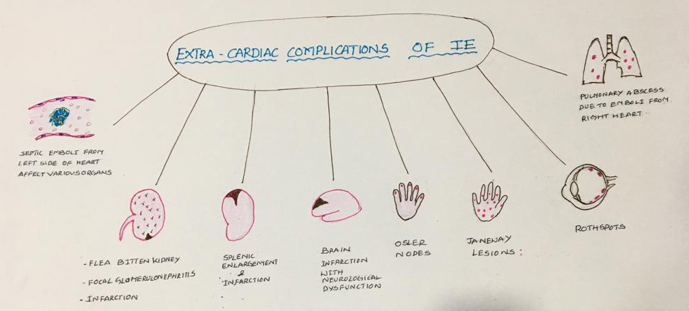 Infective endocarditis – etiopathogenesis, morphology and complications ...