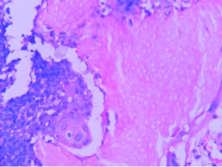 PILOMATRICOMA – Histopathology.guru