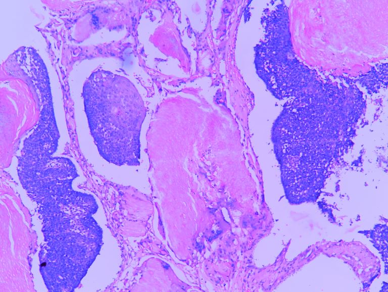 PILOMATRICOMA – Histopathology.guru