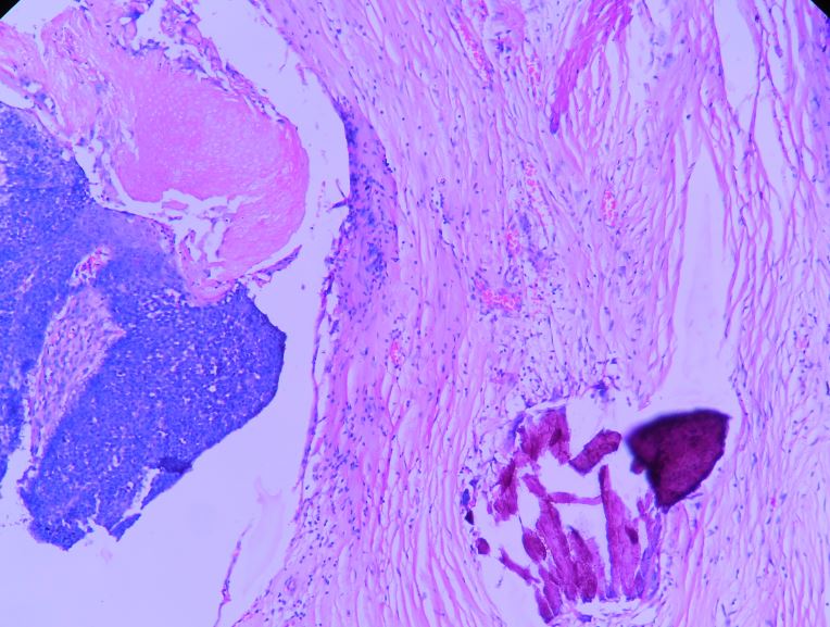 PILOMATRICOMA – Histopathology.guru