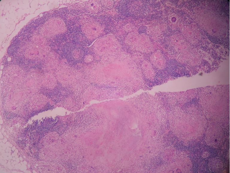 Intestinal Tuberculosis – Histopathology.guru