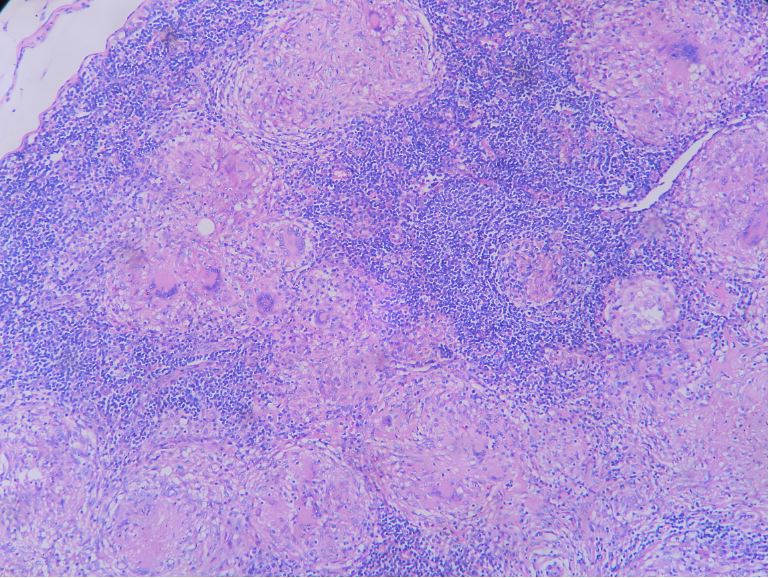 Intestinal Tuberculosis – Histopathology.guru